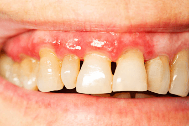 How Sugar Affects Your Teeth and Gums - Alchimie Polyclinic